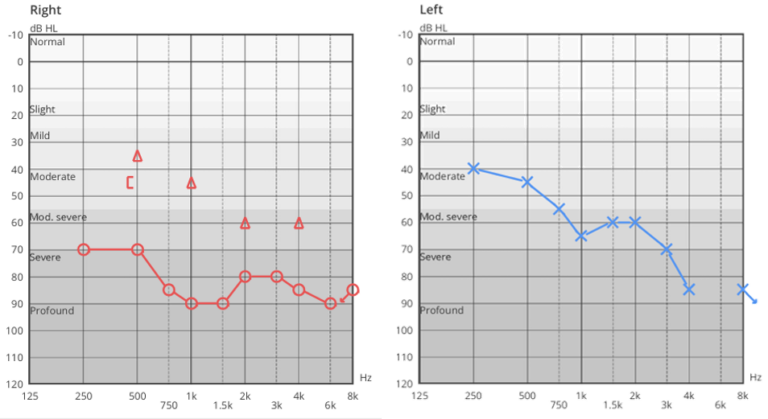 What actually is an audiogram? - Veritas Hearing UK
